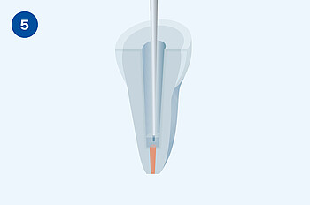 Logre la perfección con la reconstrucción de muñones y la cementación ...