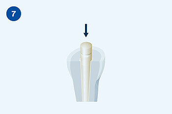Logre la perfección con la reconstrucción de muñones y la cementación ...