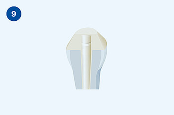 Logre la perfección con la reconstrucción de muñones y la cementación ...