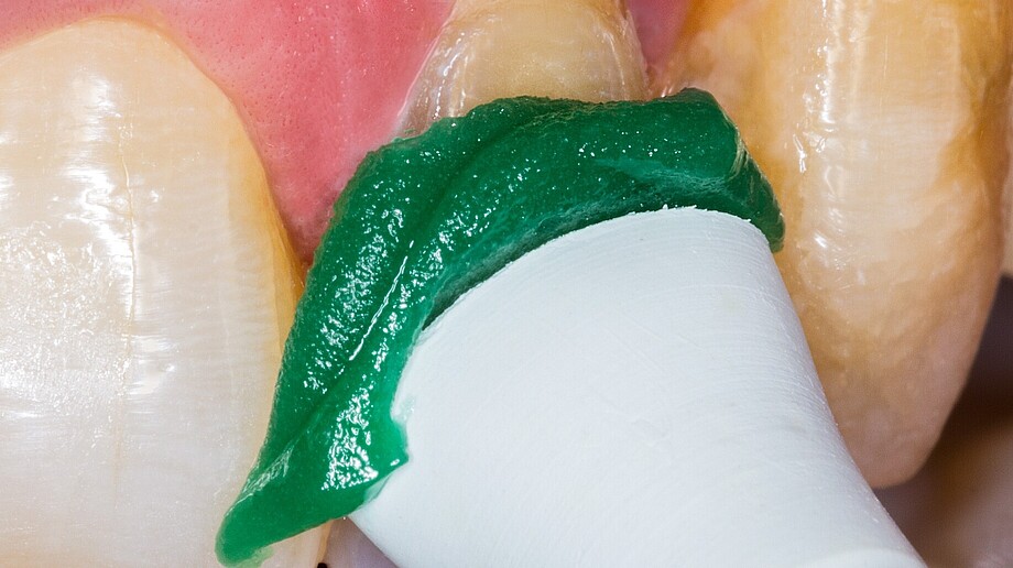 Limpieza Y Pulido Eficaz De Los Dientes Con La Pasta Profilática Flairesse