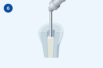 Logre la perfección con la reconstrucción de muñones y la cementación ...