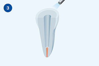 Logre la perfección con la reconstrucción de muñones y la cementación ...