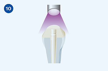 Logre la perfección con la reconstrucción de muñones y la cementación ...