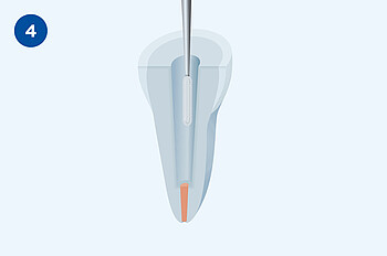 Logre la perfección con la reconstrucción de muñones y la cementación ...