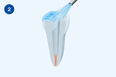 Logre la perfección con la reconstrucción de muñones y la cementación ...