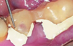 TempoCem: Self-mixing, self-curing temporary cement