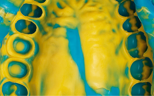 Honigum Putty: Short intraoral setting time and practical working time