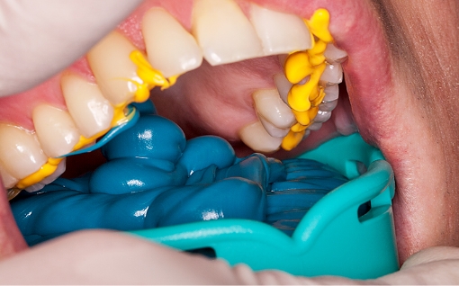 Honigum Pro Putty: Maximum precision and excellent dimensional stability