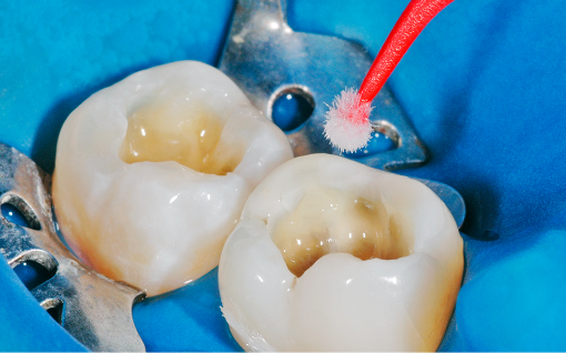 Contax: Light-curing, self-etching adhesive system